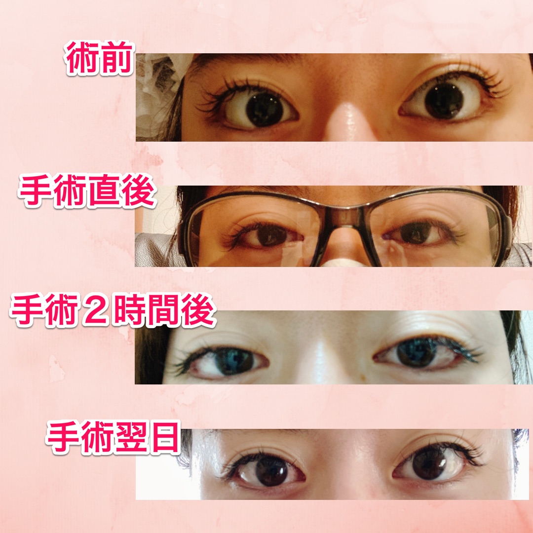 現役ナースのICL手術終了【術後当日〜術後7日までの経過記録！裸眼生活スタート】 | ジェミニの資産形成